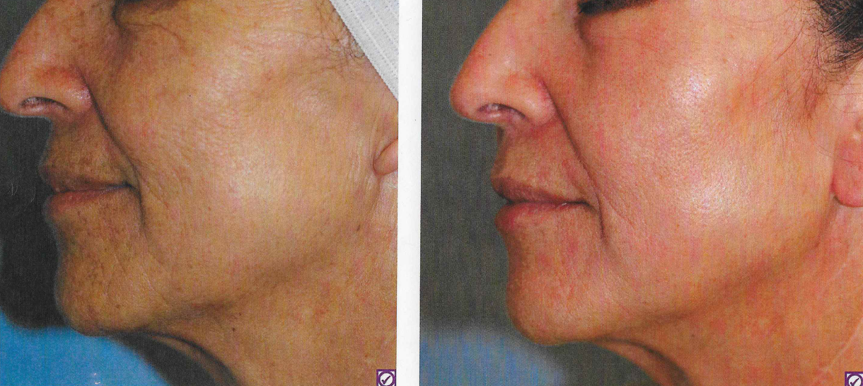 Skin Care Services Salinas | Non-Surgical Skin Rejuvenation Monterey